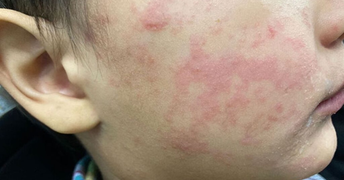 As measles cases tick higher, many NC counties could see outbreaks ...