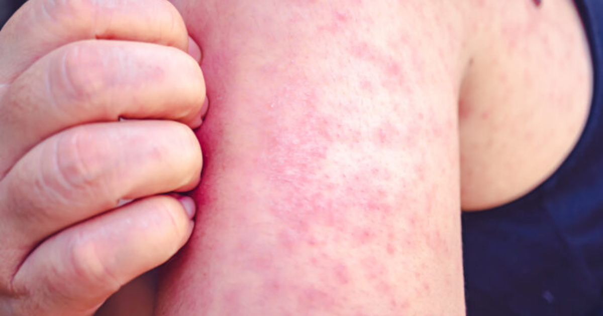 Measles exposure reported at OKC airport, Guymon Walmart over Memorial ...